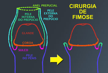 Fimose: quando operar? | Fernando Bragança - Pediatria e Homeopatia