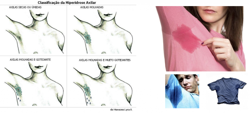 Hiperidrose (suor excessivo) | Fernando Bragança - Pediatria e Homeopatia