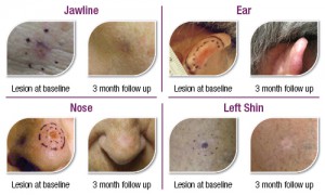 Carcinoma espinocelular | Fernando Bragança - Pediatria e Homeopatia