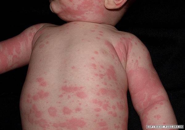 Urticária | Fernando Bragança - Pediatria e Homeopatia