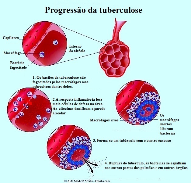 Tuberculose | Fernando Bragança - Pediatria e Homeopatia